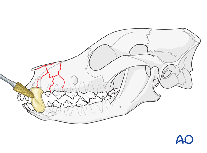 Maxillomandibular fixation for Midface, Rostral: Comminuted