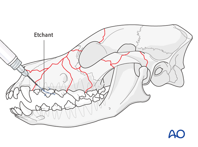 Maxillomandibular fixation for Midface, Panfacial: Nondisplaced fractures