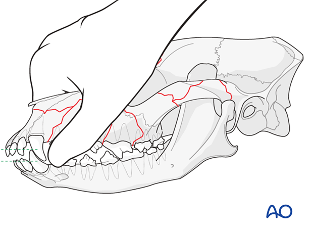 Maxillomandibular fixation for Midface, Panfacial: Nondisplaced fractures