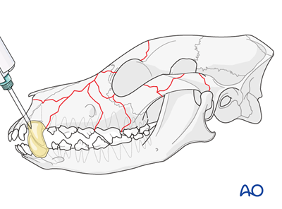 Maxillomandibular fixation for Midface, Panfacial: Nondisplaced fractures