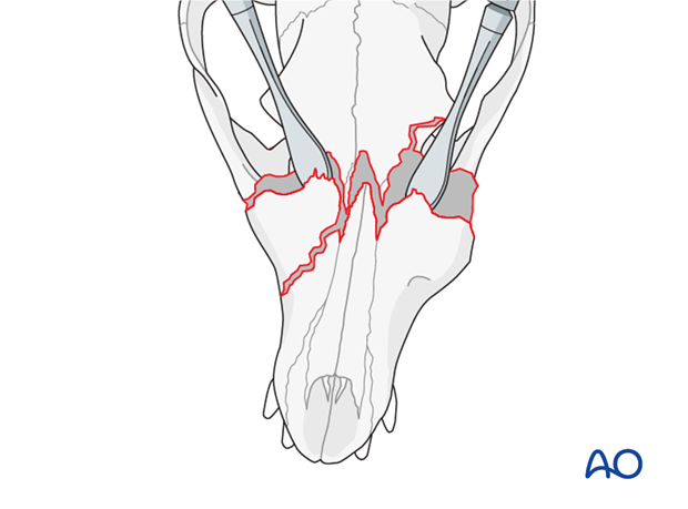 Plate fixation for Midface, Panfacial: Nondisplaced fractures