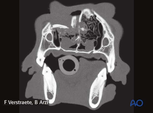 Plate fixation for Midface, Panfacial: Displaced fractures