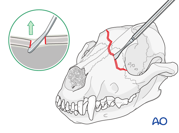 Plate fixation for Midface, Frontonasal: Simple fractures