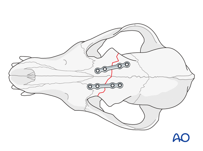 Plate fixation for Midface, Frontonasal: Simple fractures