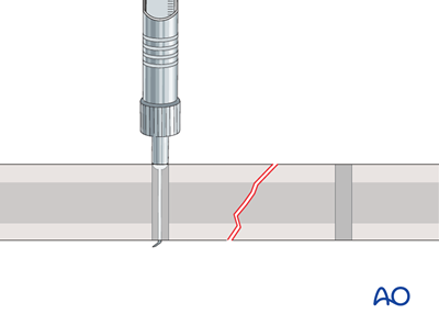 Plate fixation for Midface, Caudal: Simple fractures