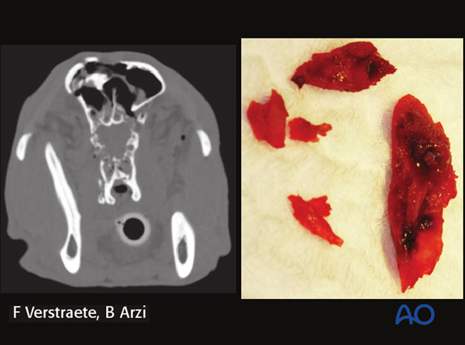 Plate fixation for Midface, Frontonasal: Simple fractures