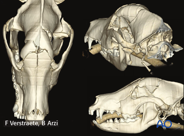 Maxillomandibular fixation for Midface, Panfacial: Nondisplaced fractures