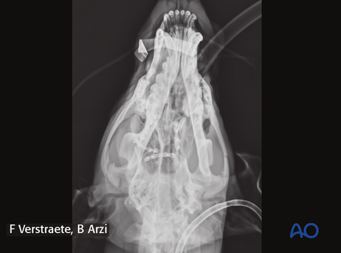 Maxillomandibular fixation for Midface, Panfacial: Nondisplaced fractures