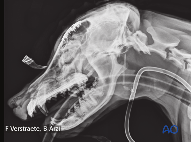 Maxillomandibular fixation for Midface, Panfacial: Nondisplaced fractures