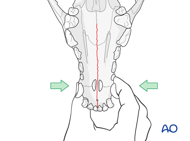 Intraoral splint fixation for Midface, Palatal: Displaced fractures