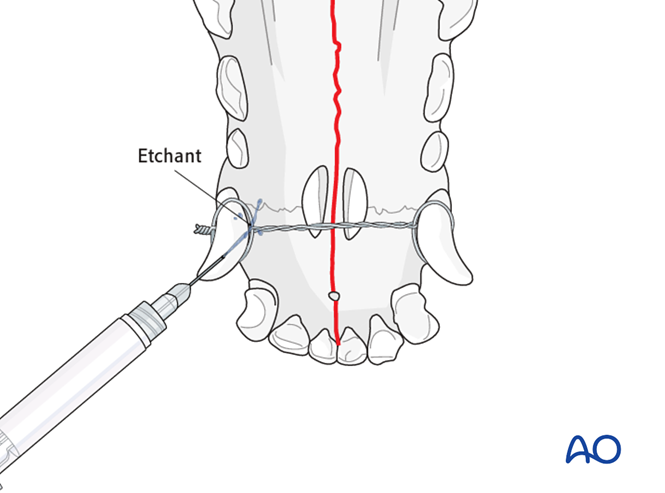 Intraoral splint fixation for Midface, Palatal: Displaced fractures