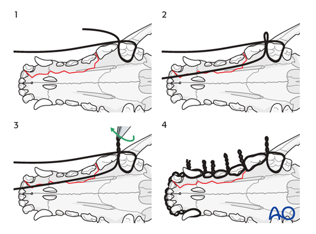 Intraoral splint fixation for Midface, Caudal: Simple fractures