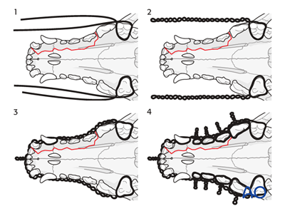 Intraoral splint fixation for Midface, Caudal: Simple fractures