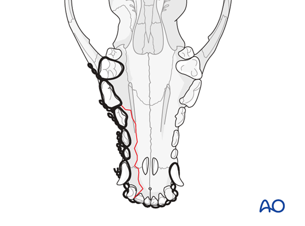 Intraoral splint fixation for Midface, Caudal: Simple fractures
