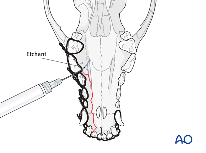 Intraoral splint fixation for Midface, Caudal: Simple fractures