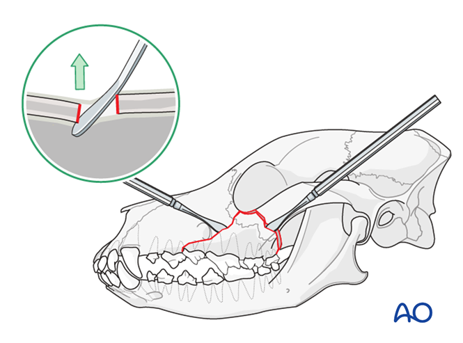 Plate fixation for Midface, Caudal: Simple fractures