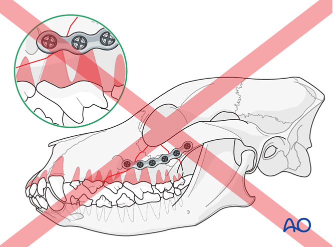 Plate fixation for Midface, Caudal: Simple fractures