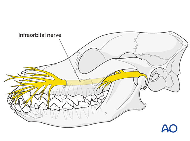 Infraorbital nerve block