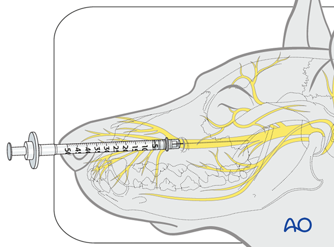 Infraorbital nerve block