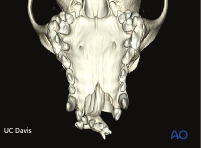 Cleft lip and palate