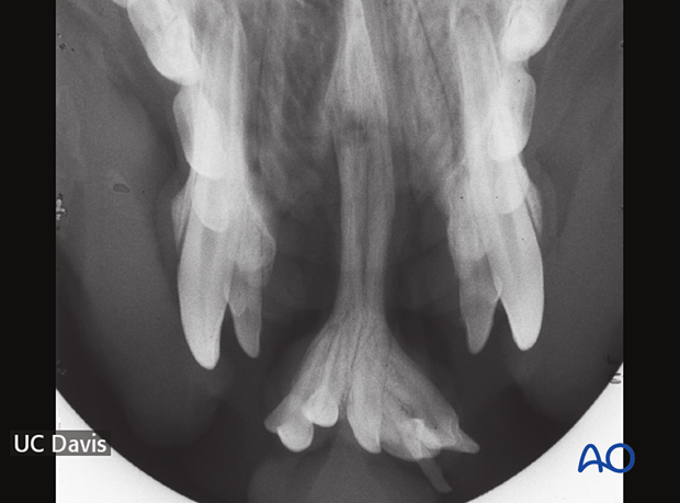 Cleft lip and palate