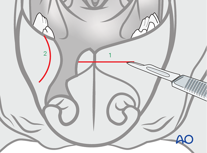Cleft lip and dentoalveolar cleft repair for Cleft lip