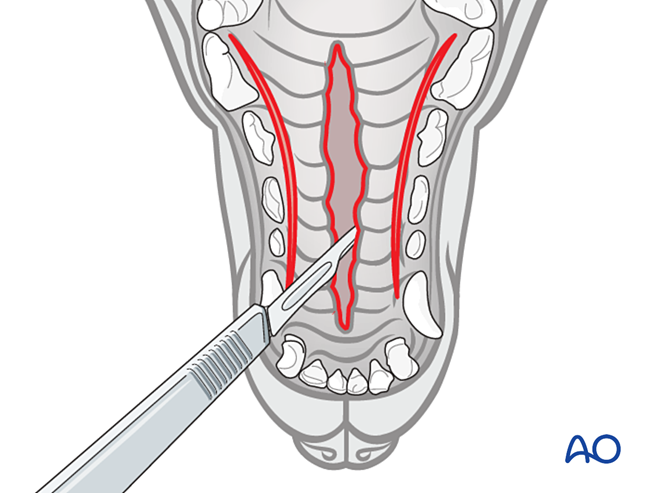 von Langenbeck technique/medially repositioned double-flap technique ...