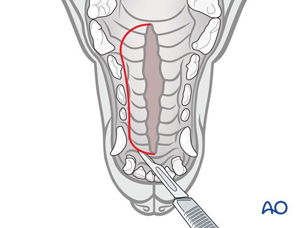 Single-layer overlapping-flap technique for Cleft hard palate