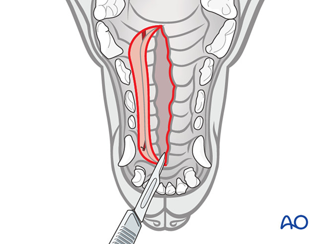 Single-layer overlapping-flap technique for Cleft hard palate