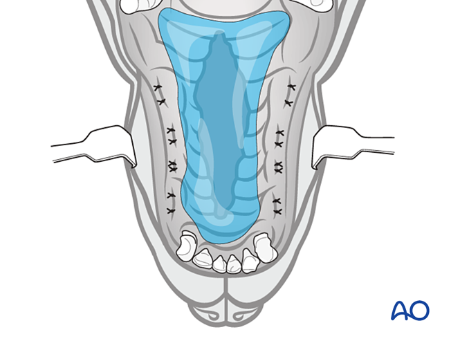 Staged double-layer closure for Cleft hard palate
