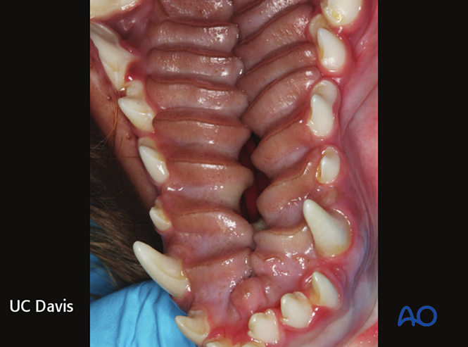 Staged double-layer closure for Cleft hard palate