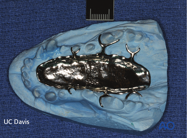 Palatal obturator for Cleft hard palate