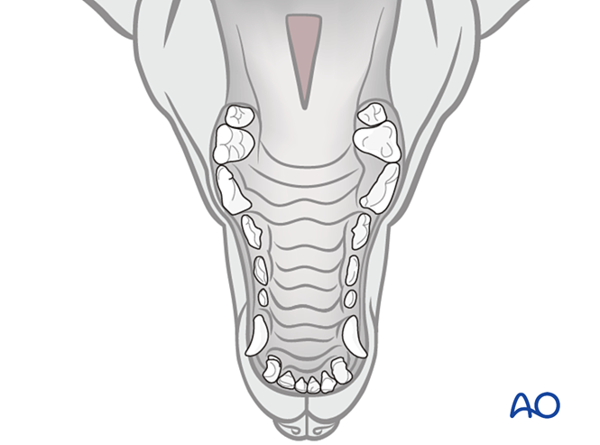 Cleft soft palate