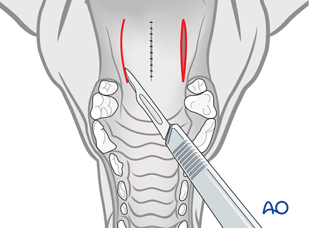 Double- or three-layer appositional technique for Cleft soft palate