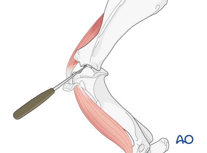 Shoulder arthrodesis for Degenerative scapulohumeral joint disease