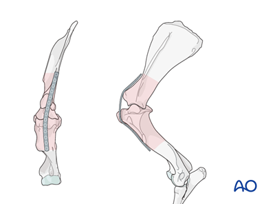 Shoulder arthrodesis for Degenerative scapulohumeral joint disease