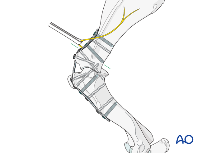 Shoulder arthrodesis for Degenerative scapulohumeral joint disease