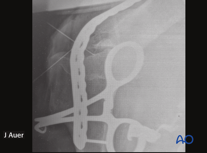 Shoulder arthrodesis for Degenerative scapulohumeral joint disease