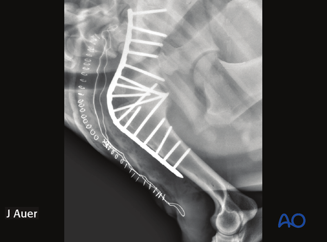 Shoulder arthrodesis for Degenerative scapulohumeral joint disease