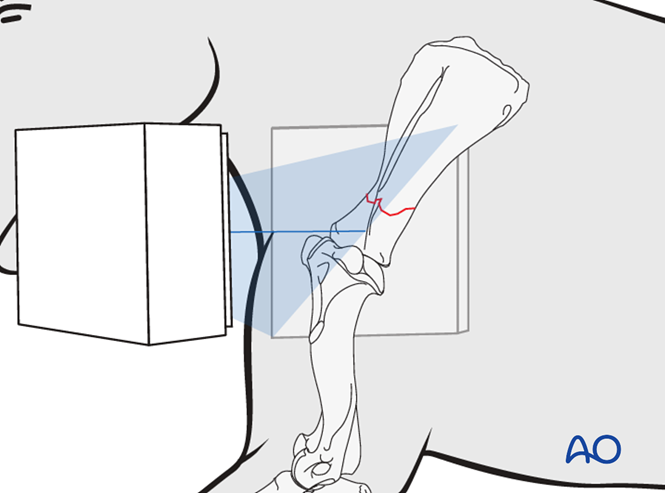 Supraglenoid tubercle fractures