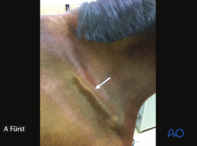 Supraglenoid tubercle fractures