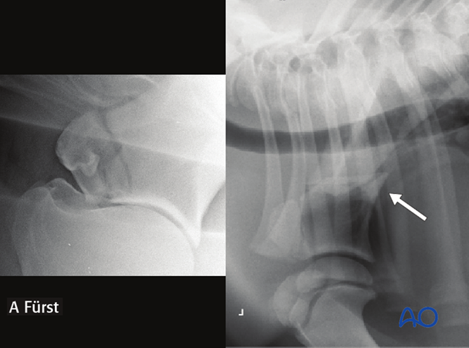 Supraglenoid tubercle fractures
