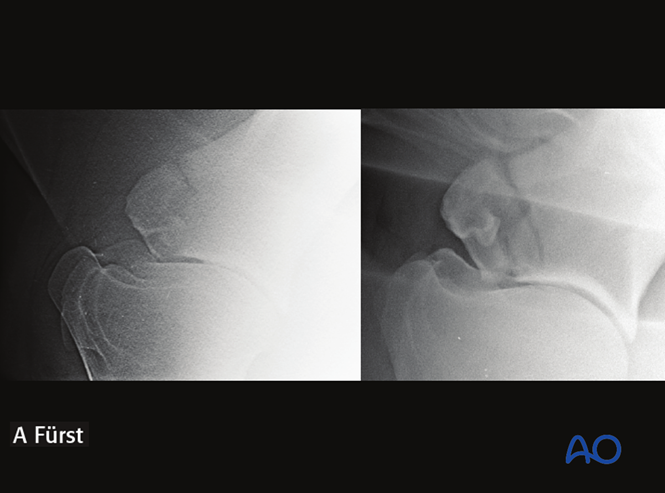 Supraglenoid tubercle fractures