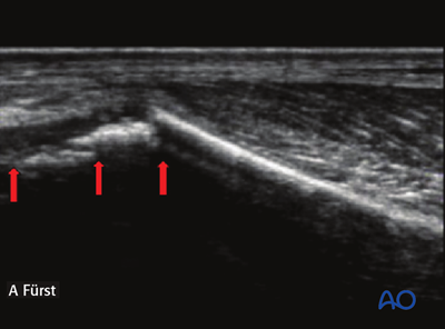 Supraglenoid tubercle fractures