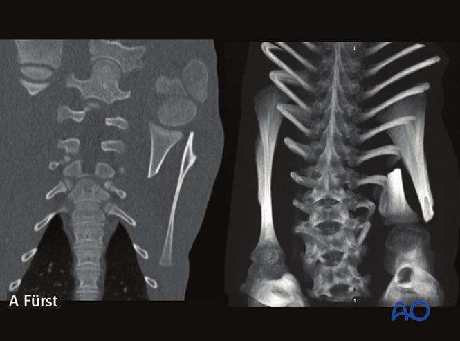 Supraglenoid tubercle fractures