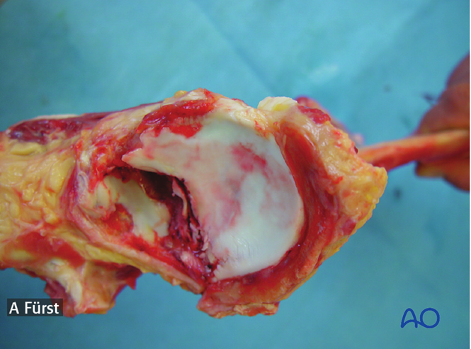 Supraglenoid tubercle fractures