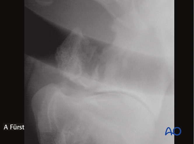 Nonsurgical fracture management for Supraglenoid tubercle fractures