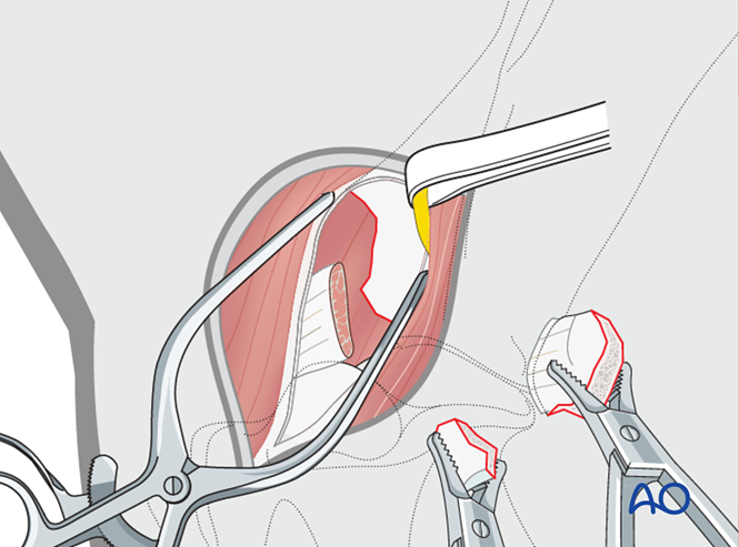 Resection for Supraglenoid tubercle fractures