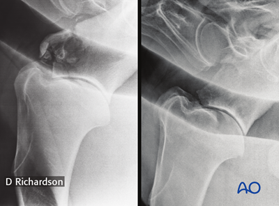 Resection for Supraglenoid tubercle fractures