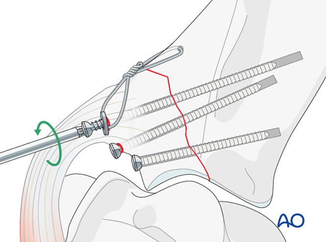 Screw fixation for Supraglenoid tubercle fractures
